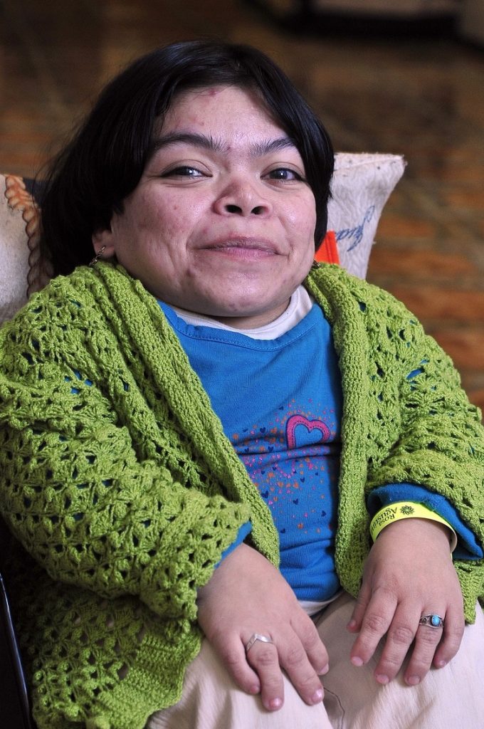 Pacientes comienzan a recibir terapia contra enfermedad de Morquio en ...